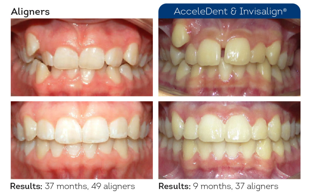 AcceleDent ® | Innovative Orthodontic Centers | Napperville IL