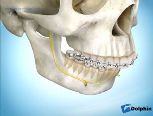 Surgical Orthodontics | Innovative Orthodontic Centers
