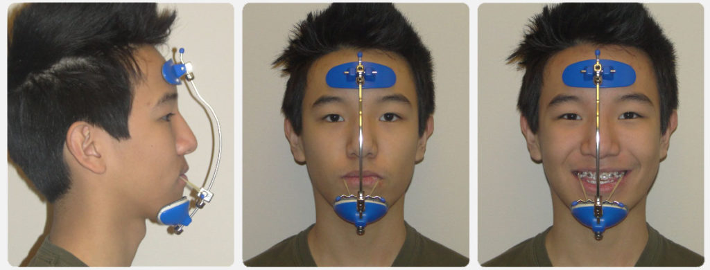 Orthodontic Appliances | Innovative Orthodontic Centers