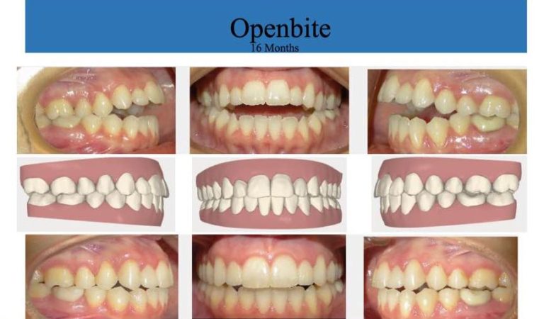 How do Braces Affect Your Face? | Face Changes With Braces